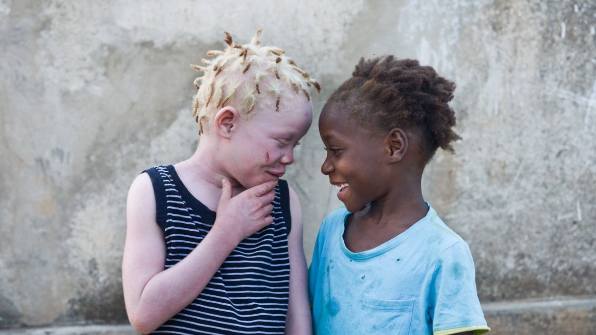 partial albino human