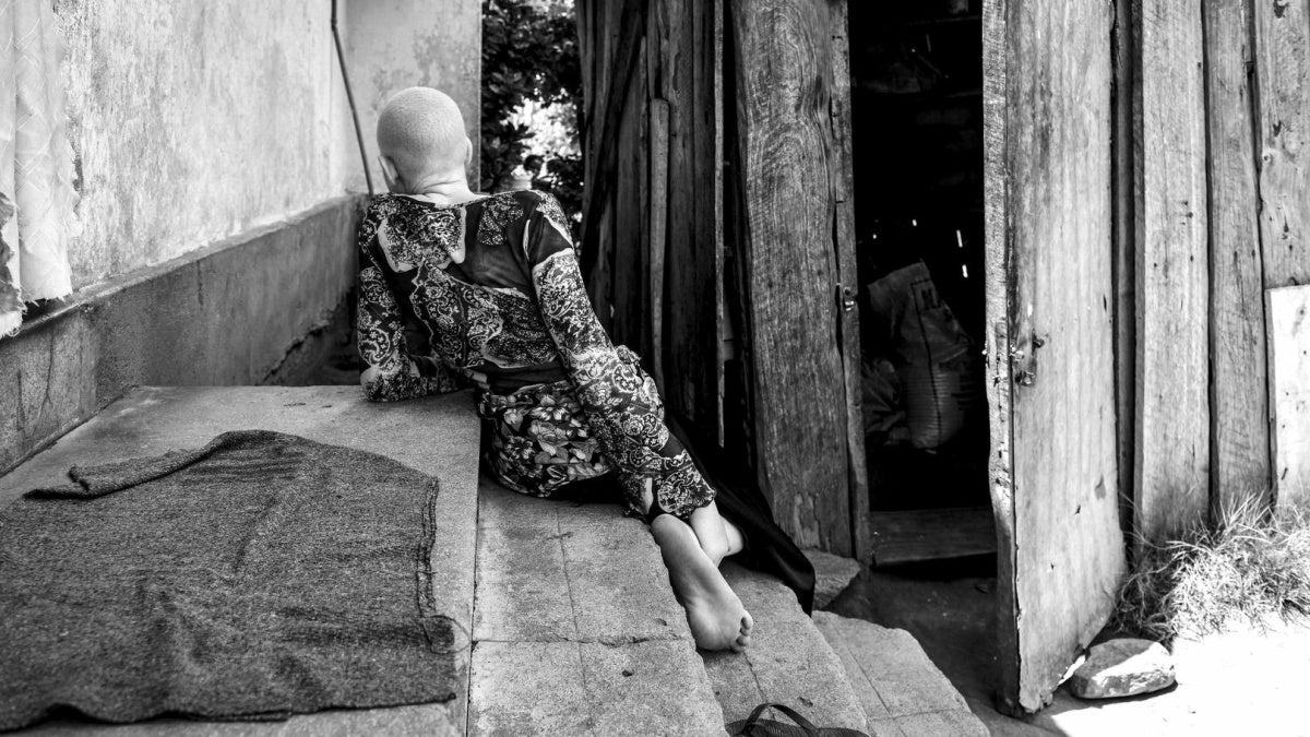 Tanzania Should Move Ahead With an Albinism Protection Plan | Human ...