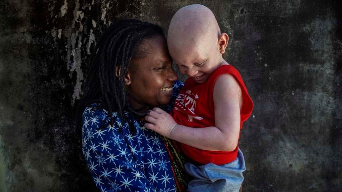 Mexican Albino People