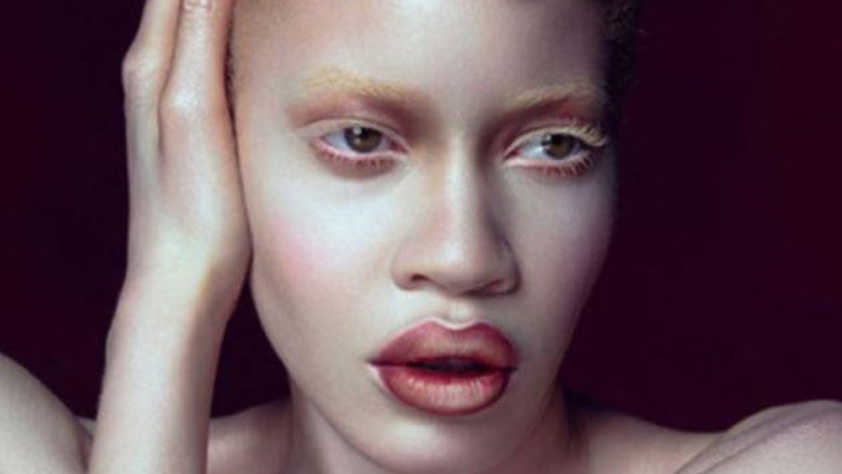People with Albinism Face Discrimination: Daily Brief | Human Rights Watch
