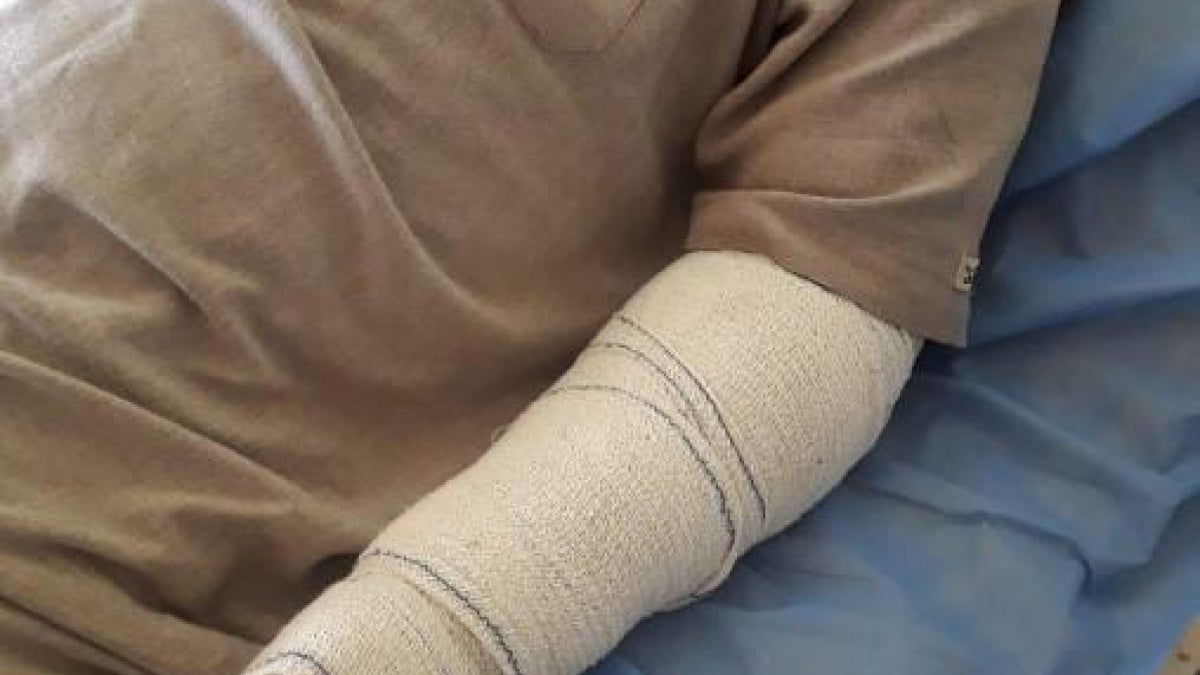 Iraq: Amputation Apparently Caused by Torture | Human Rights Watch