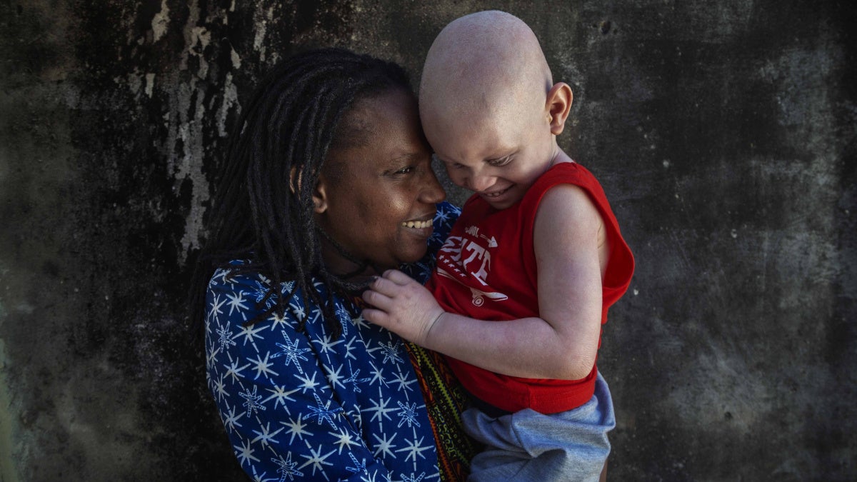 Discrimination and Barriers to Education for Persons with Albinism in ...